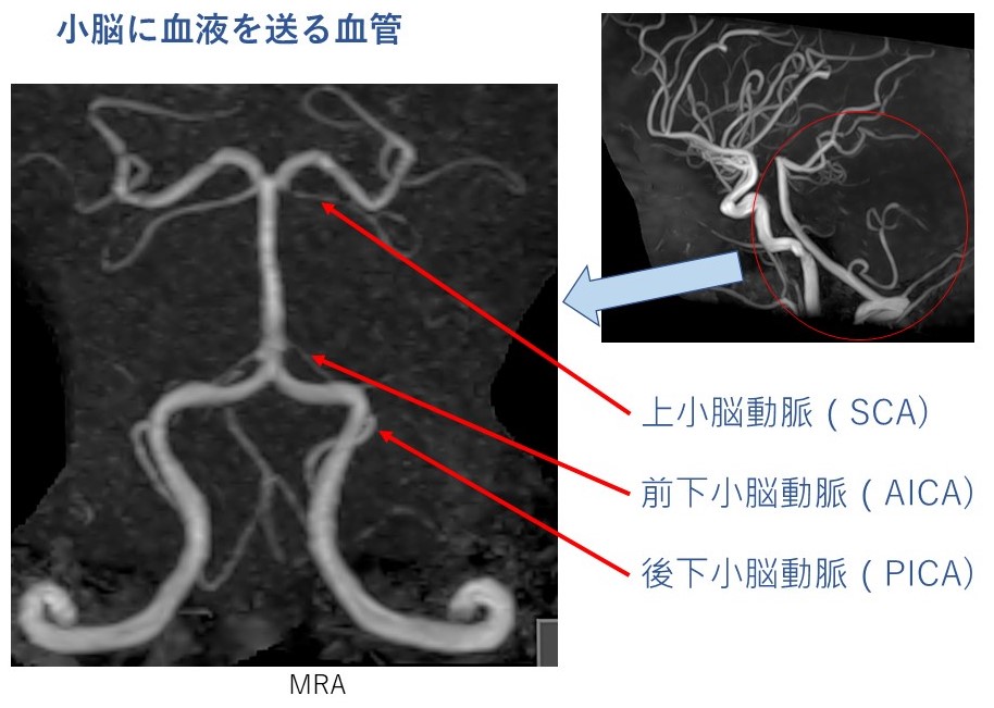 画像診断（脳血管） | 名古屋～春日井の脳神経外科 | 勝川脳神経クリニック